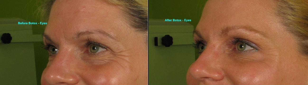 Botox Before & After Gallery - Botox Injection Therapy