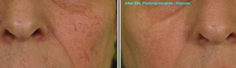 Photorejuvenation (IPL Vascular) Before & After Gallery