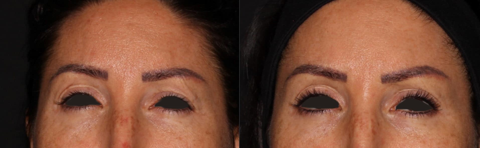 BOTOX COSMETIC® and JUVÉDERM® Dermal or Soft Tissue Filler
