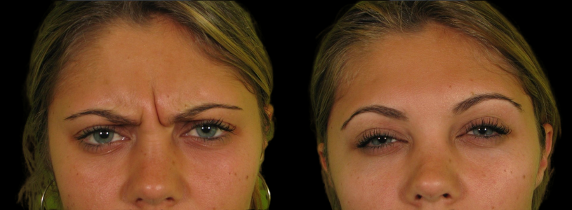 Botox Cosmetic - Live Young Medical