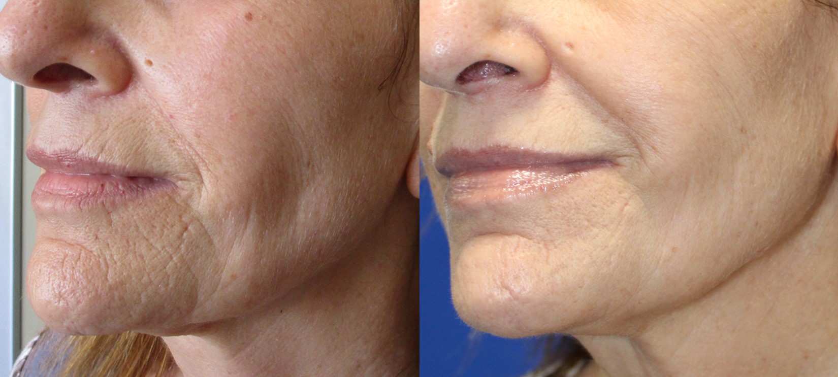 Secret RF Microneedling - Live Young Medical