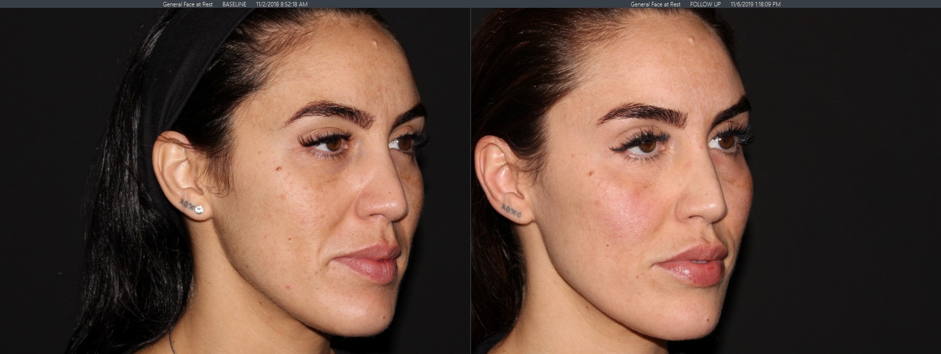 ACS Pen Microneedling CIT - Live Young Medical