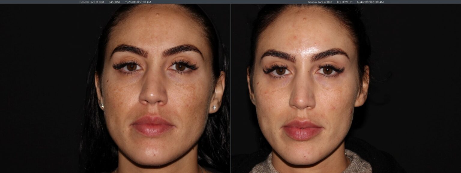 ACS Pen Microneedling CIT - Live Young Medical