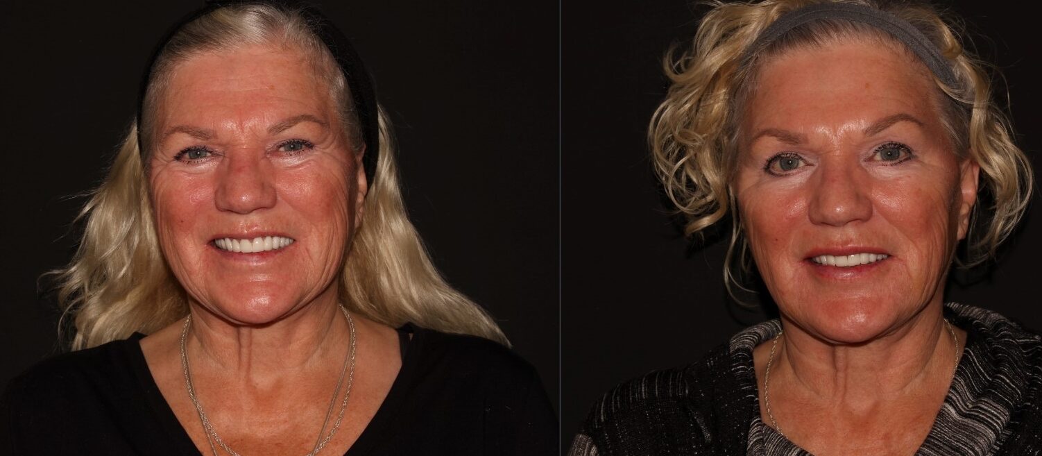 The Soft Lift - Live Young Medical